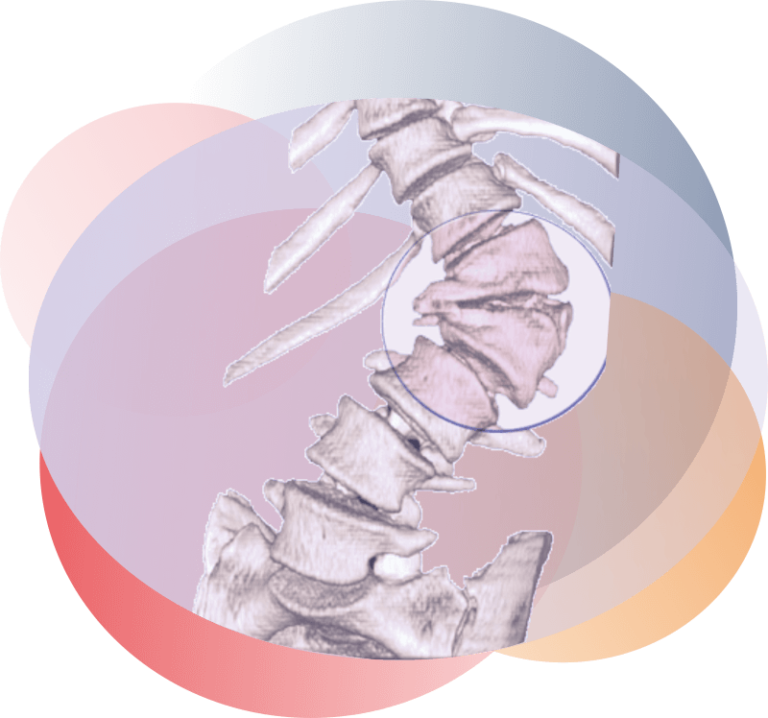 Congenital Scoliosis